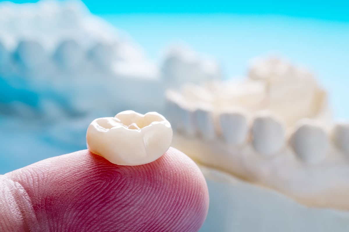 CEREC vs Traditional Crowns: Comparing Speed, Durability & Cost - Greer ...